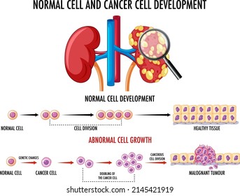 Diagram Showing Cancer Development Process Illustration Stock Vector ...