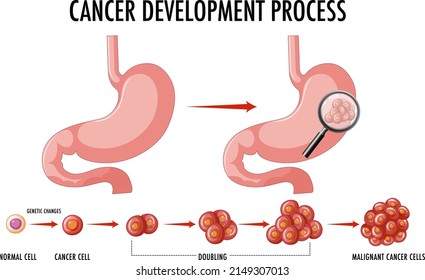 Diagram Showing Cancer Development Process Illustration Stock Vector ...