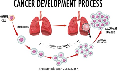 Diagram Showing Cancer Development Process Illustration Stock Vector ...