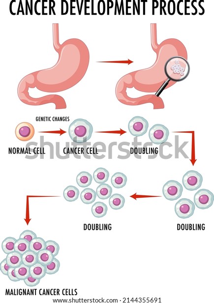 Diagram Showing Cancer Development Process Illustration: เวกเตอร์สต็อก ...