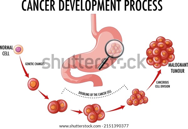 Stock vektor „Diagram Showing Cancer Development Process Illustration ...