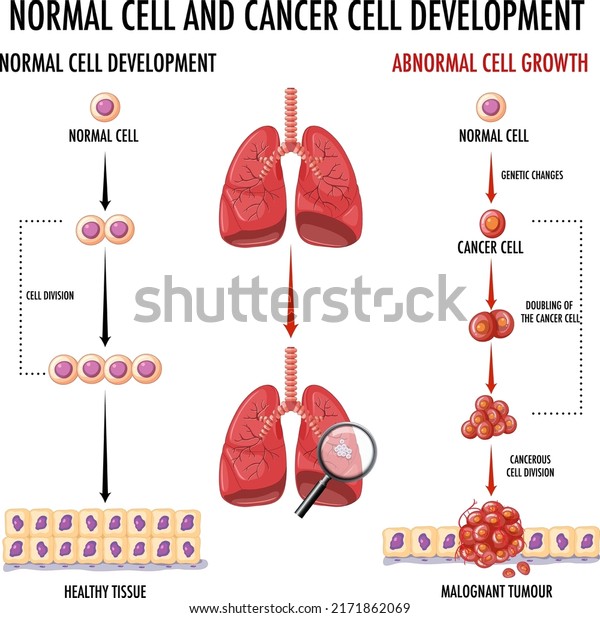 Diagram Showing Cancer Development Process Illustration 库存矢量图（免版税 ...