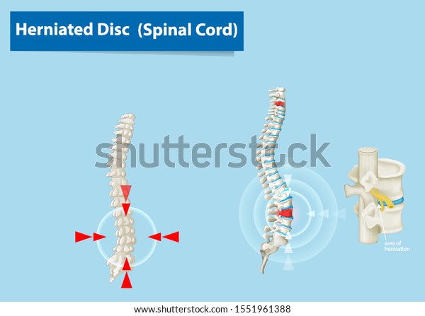 Diagram Showing Herniated Disc Human Illustration Stock Vector (Royalty ...