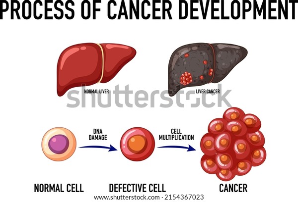 Diagram Showing Process Cancer Development Illustration Stock Vector ...