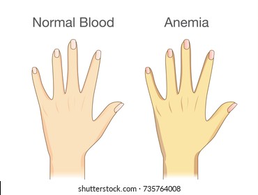 232 Hemoglobin in body skin Images, Stock Photos & Vectors | Shutterstock