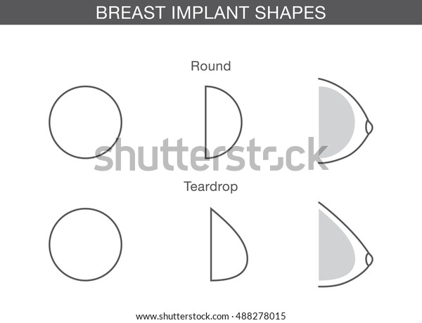 Vektor Stok Difference Breast Implant Round Teardrop Shapes (Tanpa ...