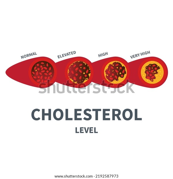 Vektor Stok Different Stages Cholesterol Plaque Buildup Artery (Tanpa ...