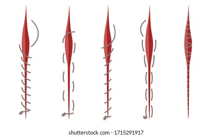 Different Surgical Stitches Isolated On White Stock Vector (Royalty ...