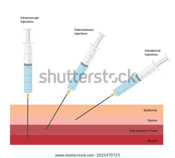Differents Syringe Angles Injections Intramuscular Subcutaneous ...