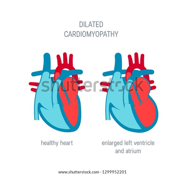 Dilated Cardiomyopathy Disease Concept Vector Illustration Stock Vector ...