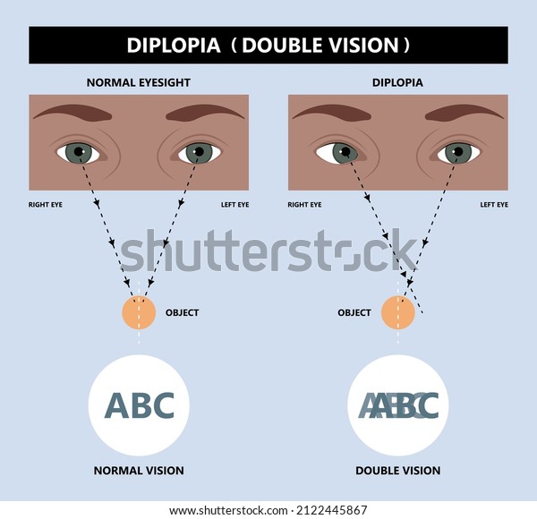 225 Diplopia Images, Stock Photos & Vectors | Shutterstock
