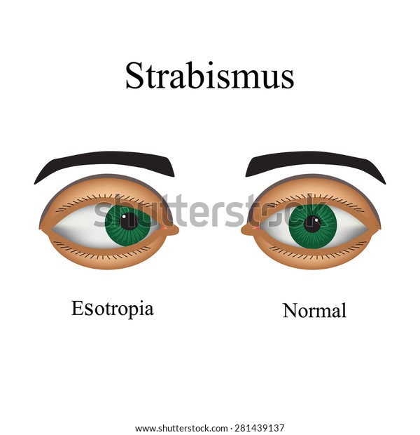Diseases Eye Strabismus Variation Strabismus Esotropia Stock Vector ...