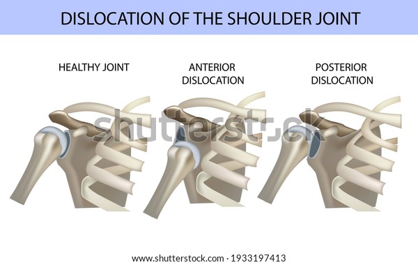 Dislocation Shoulder Joint Medical Vector Illustration Stock Vector ...