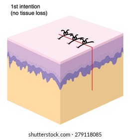 Drawing Simple Skin Wound No Tissue Stock Vector (Royalty Free ...