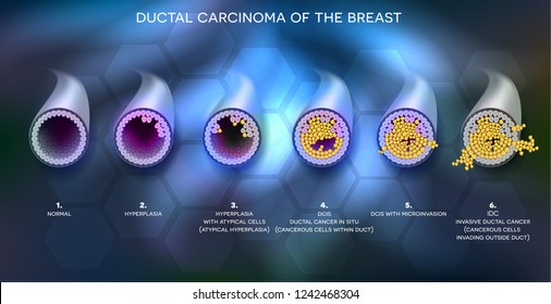 Ductal Carcinoma Breast Detailed Medical Illustration Stock Vector ... Ductal Carcinoma Breast Detailed Medical Illustration Stock Vector ...