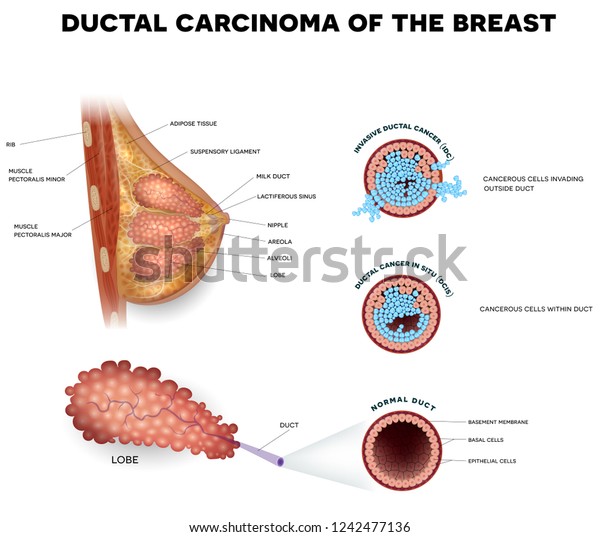 Ductal Carcinoma Breast Detailed Medical Illustration Stock Vector ... Ductal Carcinoma Breast Detailed Medical Illustration Stock Vector ...