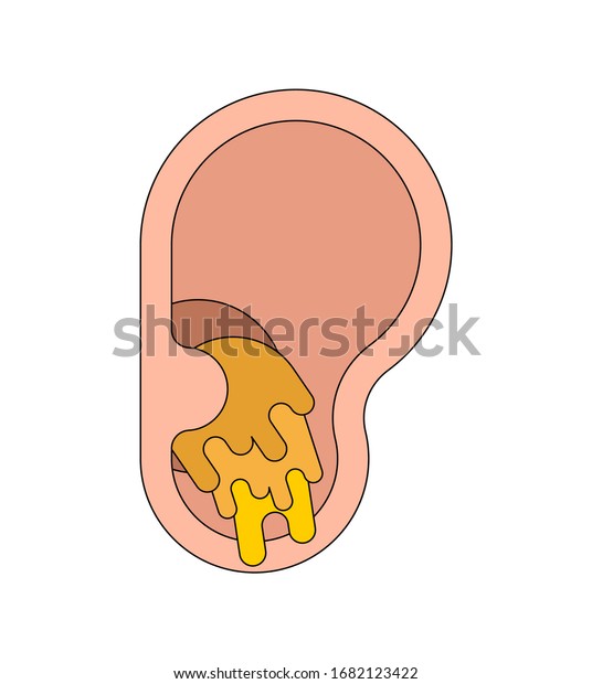 Ear Plug Earwax Ear Isolated Cerumen Stock Vector (Royalty Free ...