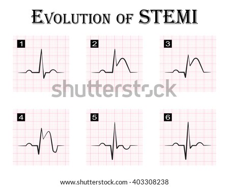 ECG Evolution Step By Step STEMI Stock Vector (Royalty Free) 403308238 ...