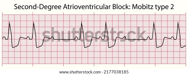 Ecg Line Seconddegree Atrioventricular Block Mobitz: vetor stock (livre ...
