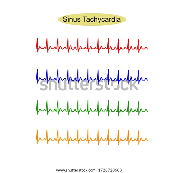 ECG de Sinus Tachycardia, Sinus Tach : image vectorielle de stock ...