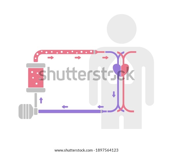 Ecmo Extracorporeal Membrane Oxygenation Structure Vector: เวกเตอร์ ...