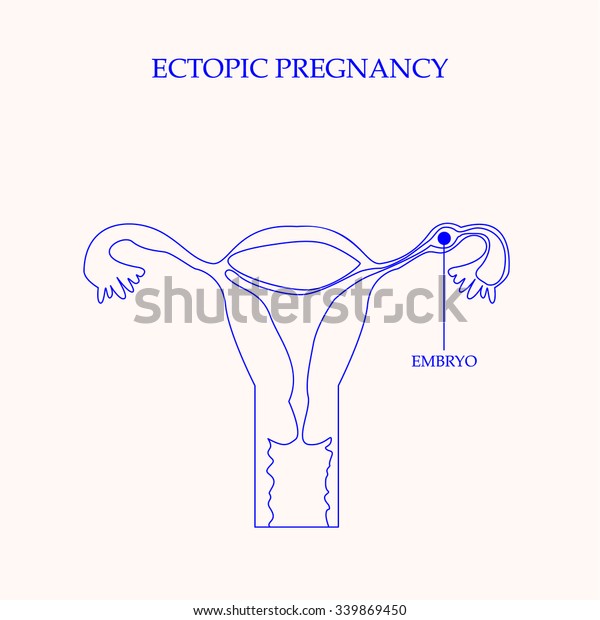 Ectopic Pregnancy Concept Vector Illustration Stock Vector (Royalty ...