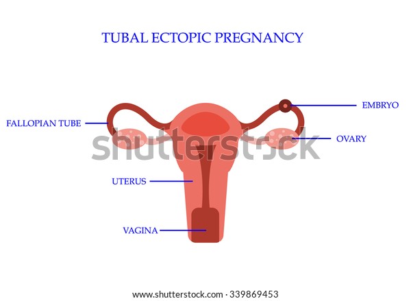 Ectopic Pregnancy Concept Vector Illustration Stock Vector Royalty