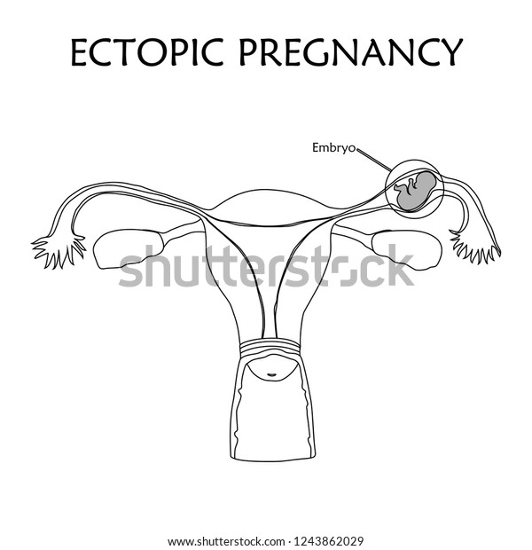 Ectopic Pregnancy Embrio Fetus Fallopian Tube Stock Vector (Royalty ...