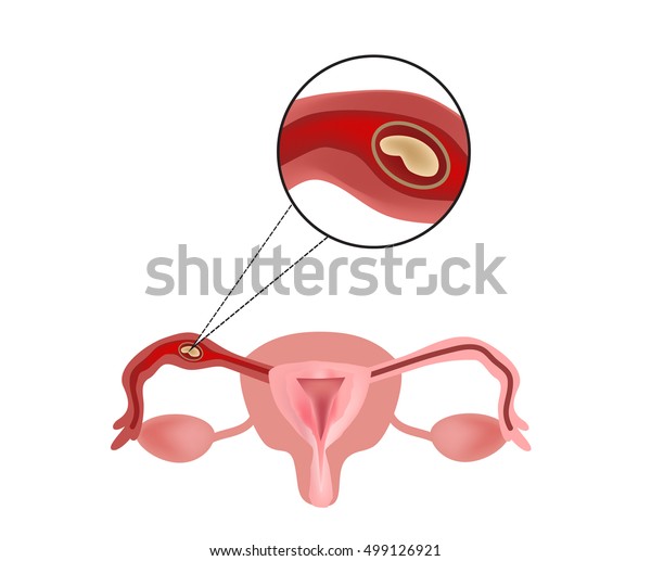 Ectopic Pregnancy Embryo Fallopian Tube Infographics: เวกเตอร์สต็อก ...