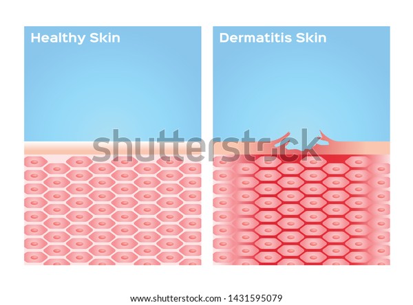 Eczema Skin Skin Dermatitis Disease Vector 库存矢量图（免版税）1431595079 ...