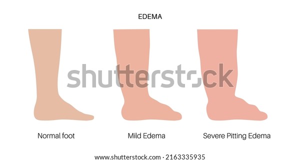 Edema Disease Concept Oedema Fluid Retention Stock Vector (Royalty Free ...