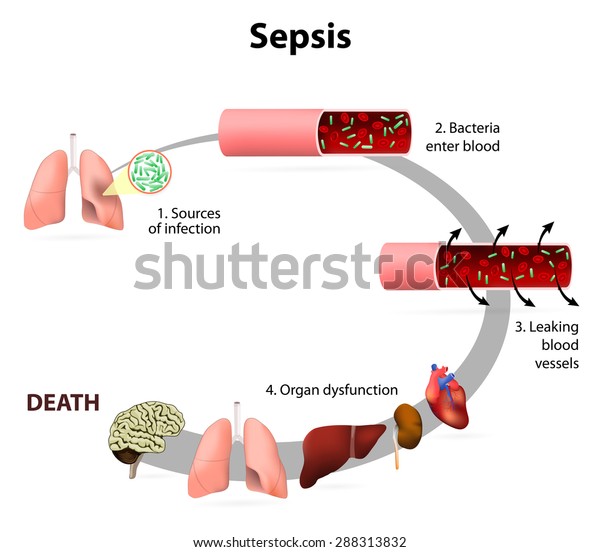 Effects Sepsis Presence Numerous Bacteria Blood: เวกเตอร์สต็อก (ปลอดค่า ...