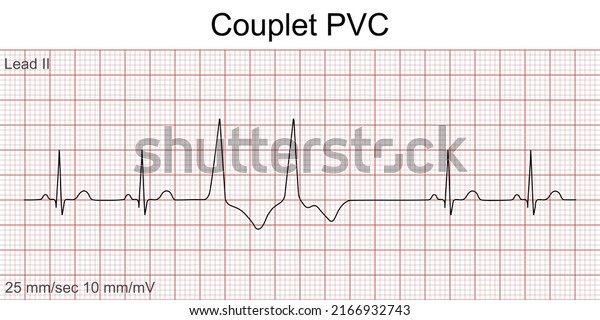 El electrocardiograma muestra el patrón de: vector de stock (libre de ...