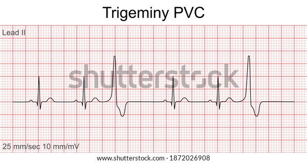 Electrocardiogram Show Trigeminy Pvc Pattern Heart Stock Vector ...
