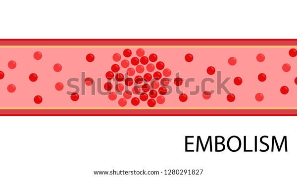 Embolism Cartoon Vector Wallpaper Blood Vessel Stock Vector (Royalty ...
