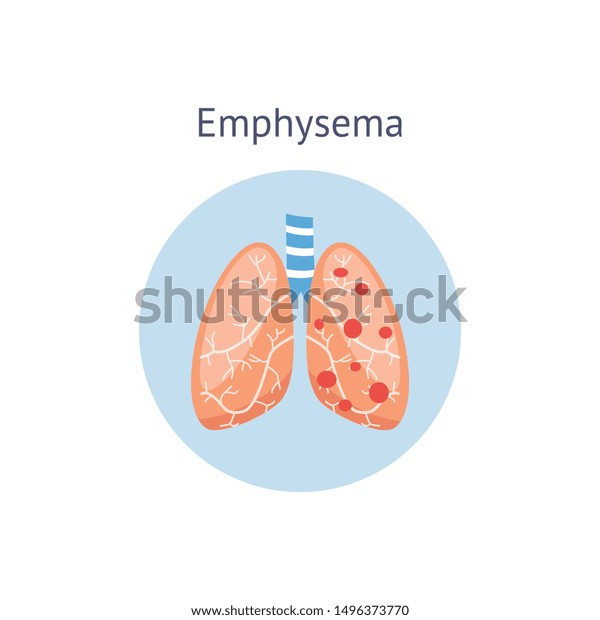 Emphysema Chronic Obstructive Pulmonary Disease Diagram Stock-vektor ...