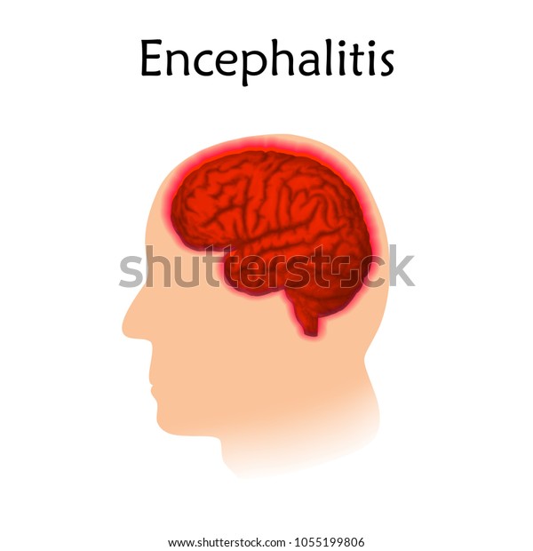 Encephalitis Vector Medical Illustration White Background Stock Vector ...