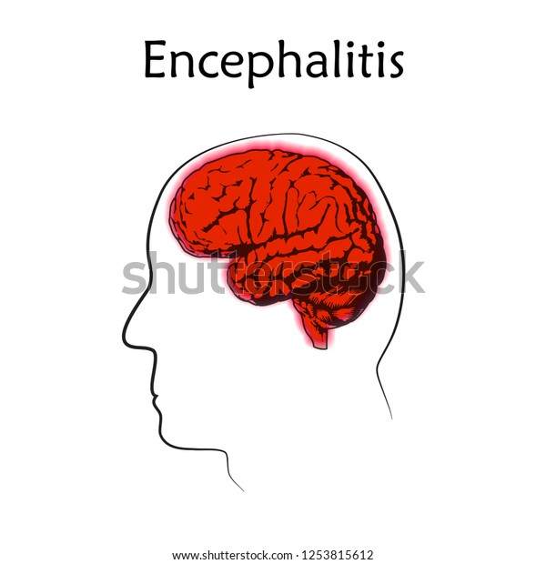 Encephalitis Vector Medical Illustration White Background Stock Vector ...