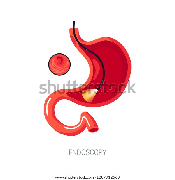 Endoscopy Diagnostic Concept Human Stomach Endoscope Stock Vector ...