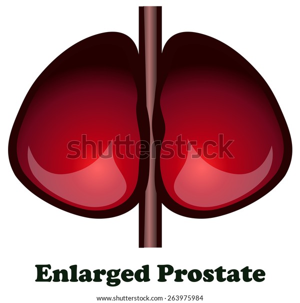 Enlarged Prostate Vector Illustration Stock Vector (Royalty Free ...