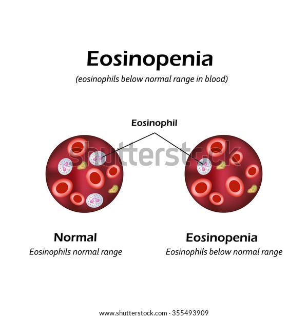 Eosinophils Below Normal Range Blood Eosinopenia Stock Vector (Royalty ...