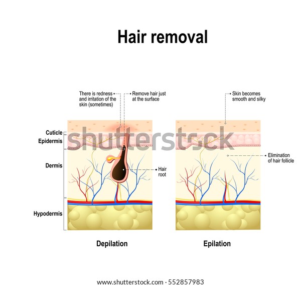 Epilation Depilation Difference Hair Removal Human Stock Vector ...