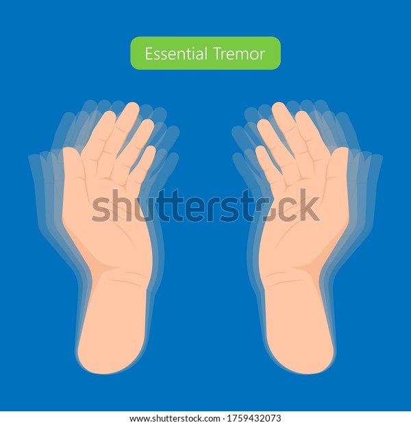 Essential Tremor Deep Brain Stimulation Dbs Stock Vector (Royalty Free ...