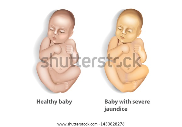Extent Jaundice Icterus Baby Stock Vector (Royalty Free) 1433828276