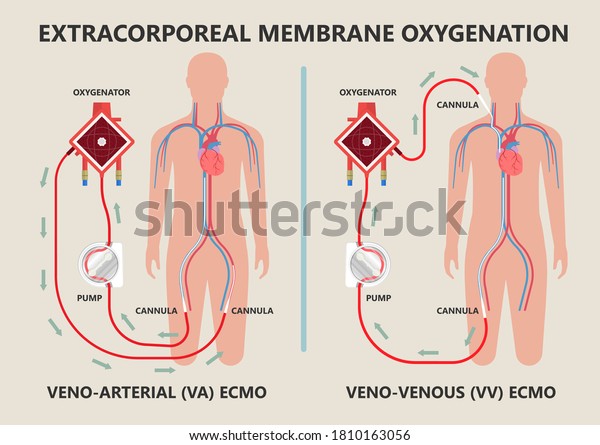 Extracorporeal Membrane Oxygenation Ecmo Life Support Stock Vector ...