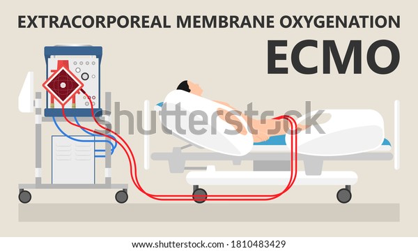 Extracorporeal Membrane Oxygenation Ecmo Life Support Stock Vector ...