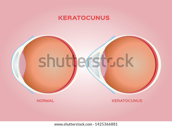Stock vektor „Eye Cornea Keratoconus Vector Anatomy“ (bez autorských ...