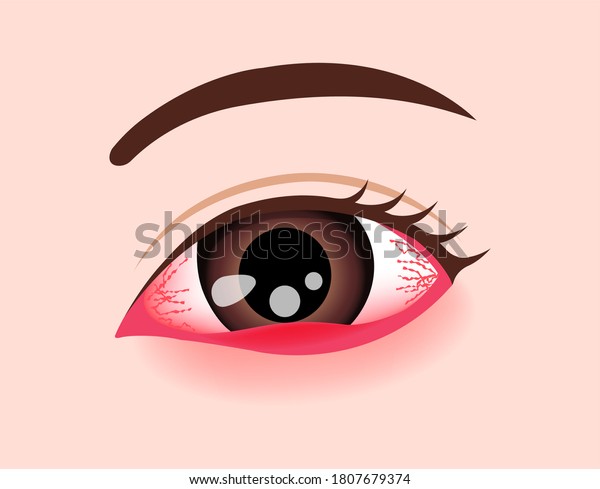 Eye Disease Vector Illustration Stye Hordeolum: เวกเตอร์สต็อก (ปลอดค่า ...