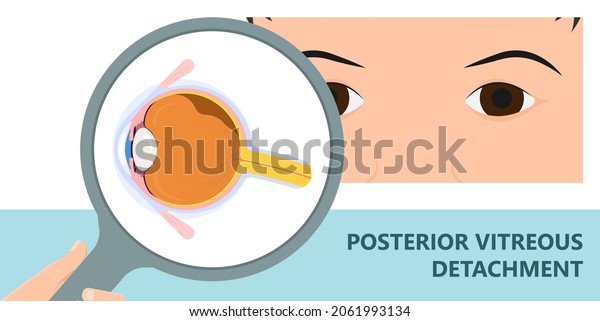 Eye Floaters Fluid Vision Retina Myopia Stock Vector (Royalty Free ...