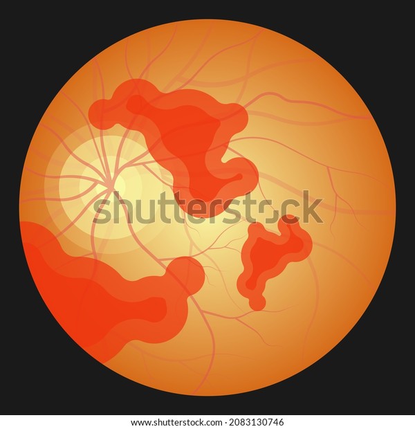 Eye Floaters Fluid Vision Retina Myopia Stock Vector (Royalty Free ...